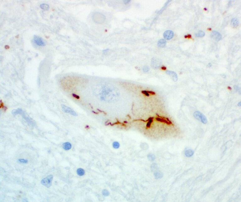 ALS Genetic Mutations Explained - Understanding ALS Genetics